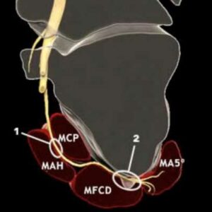 La neuralgia de Baxter. La falsa "Fascitis Plantar" - EOM Internacional